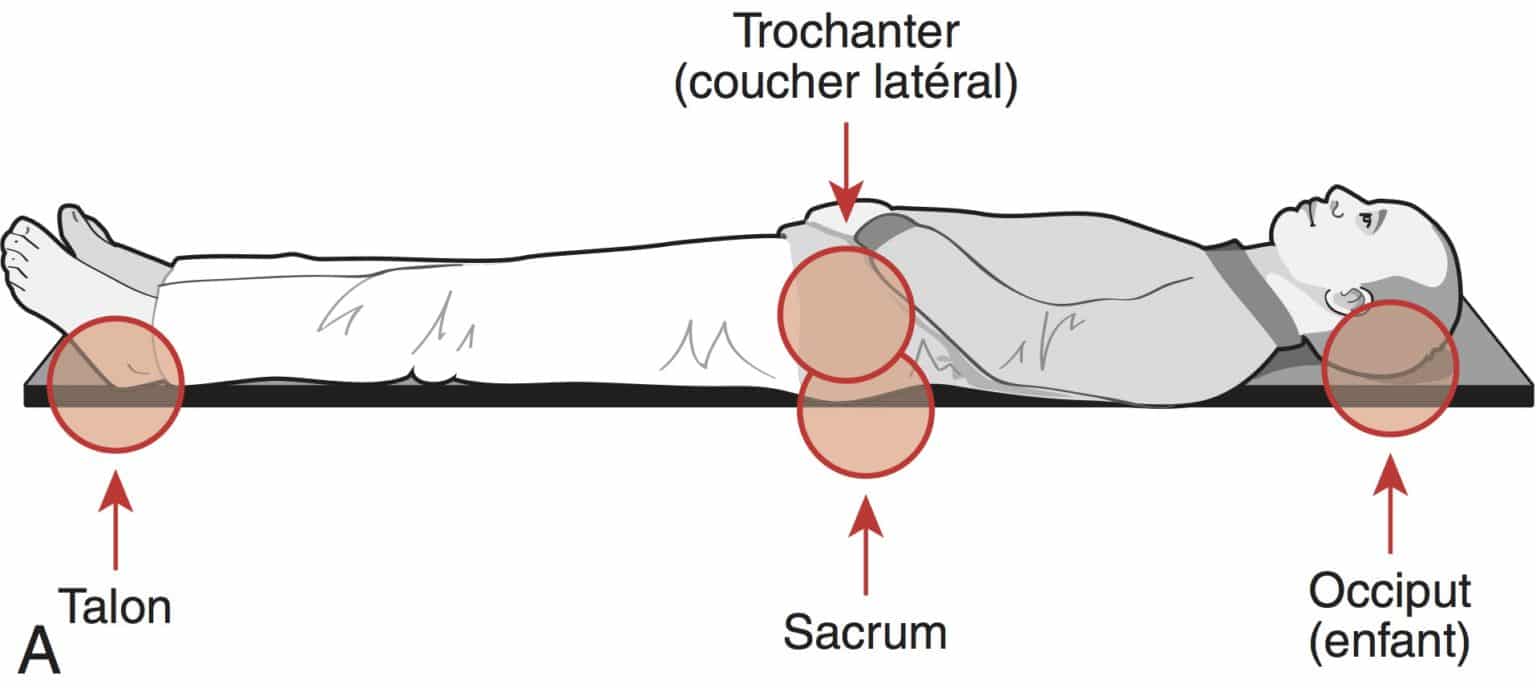 Escarres : l'échelle de Braden pour prédire le risque d'escarres ...