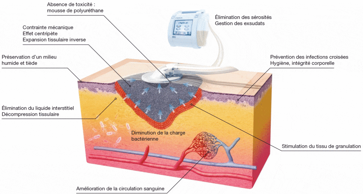 La TPN Thérapie par Pression Négative : objectifs et mode d’emploi ...