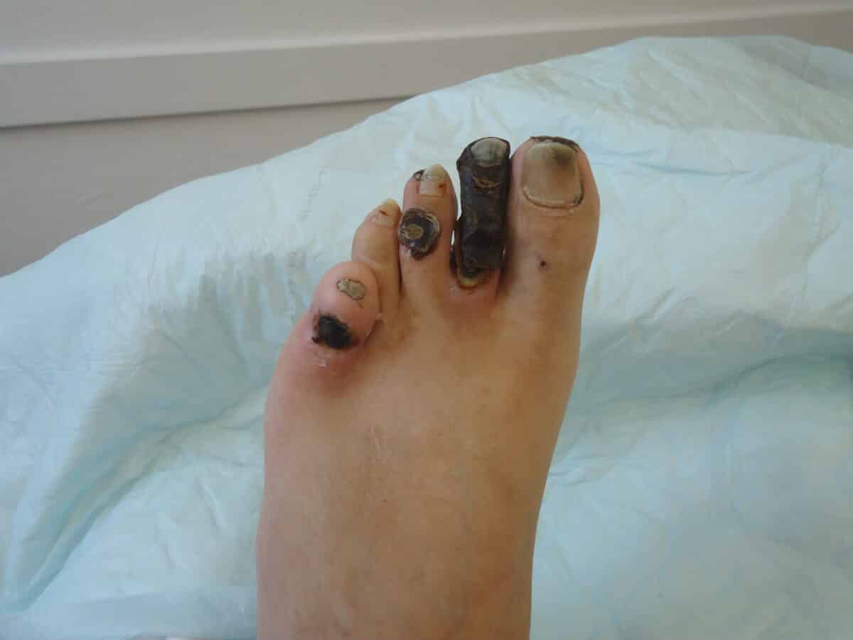 Ulcères de jambe, du diagnostic au traitement - Actusoins actualité ...