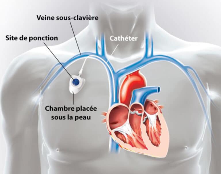 Le cathéter à chambre implantable, un dispositif médical aux multiples ...