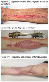 Le syndrome des loges aigu : un « coup de tonnerre dans un ciel serein ...