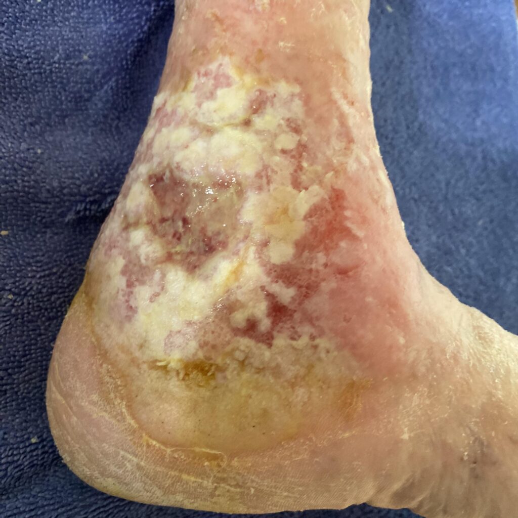 Comprendre les ulcères de jambe : causes et traitements - Actusoins