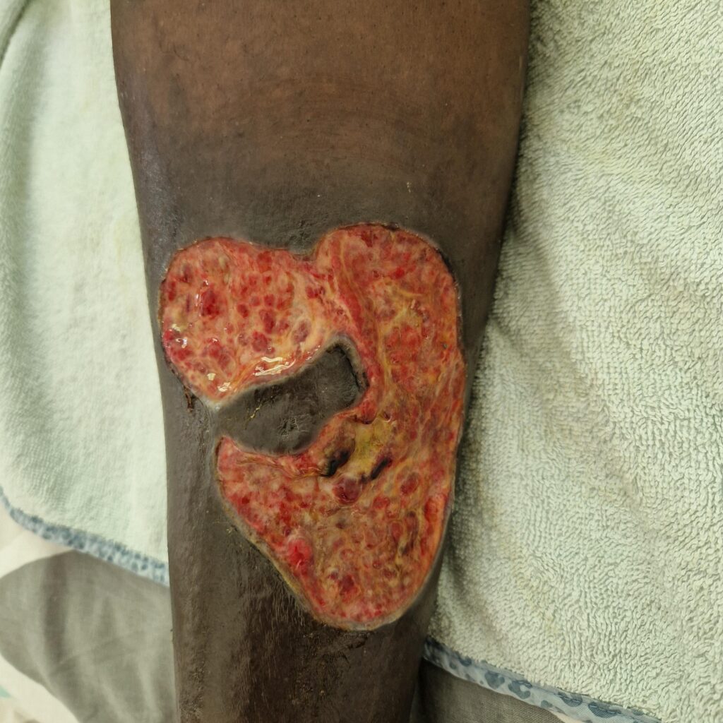 Comprendre les ulcères de jambe : causes et traitements - Actusoins