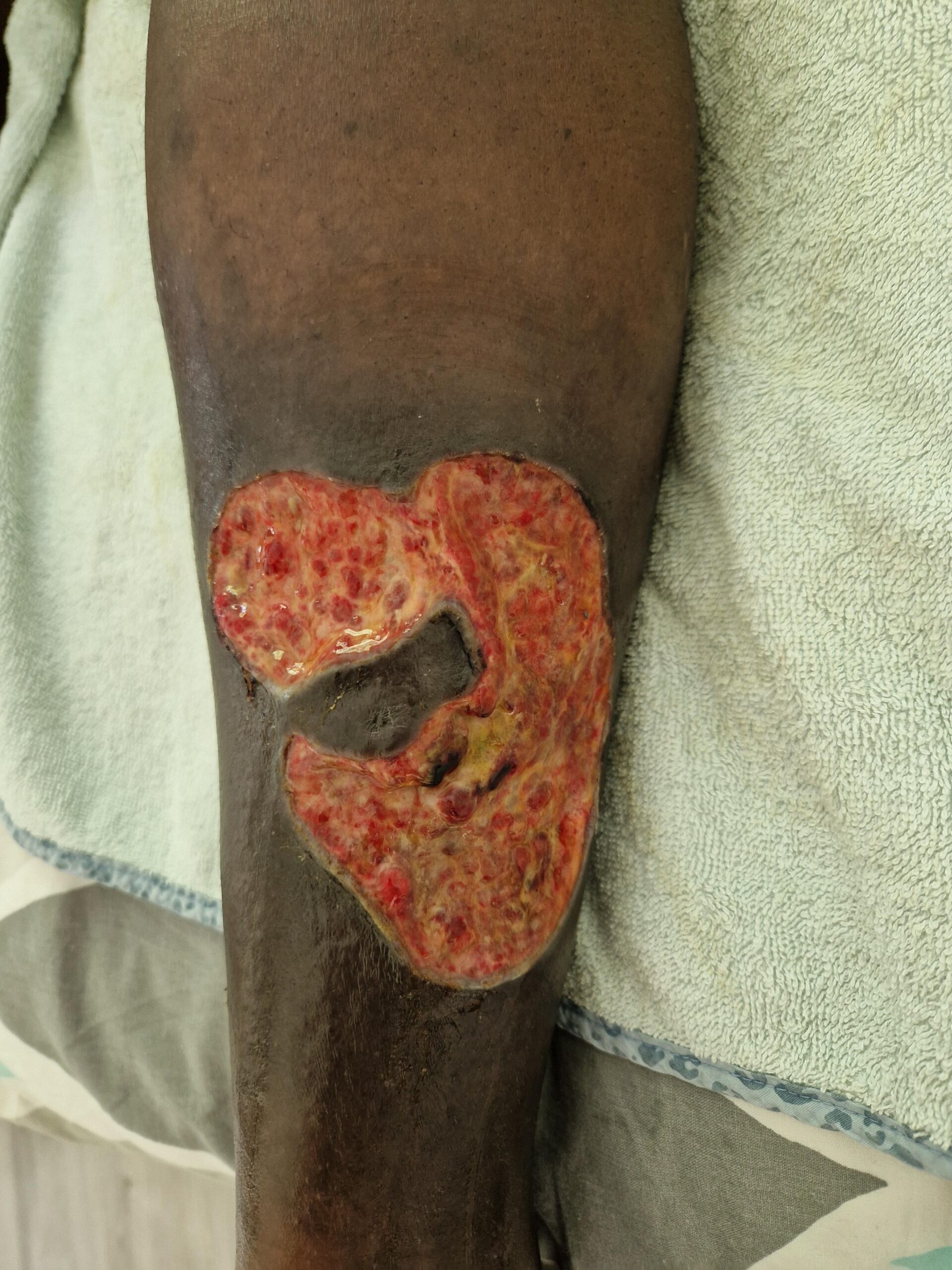 Comprendre les ulcères de jambe : causes et traitements - Actusoins