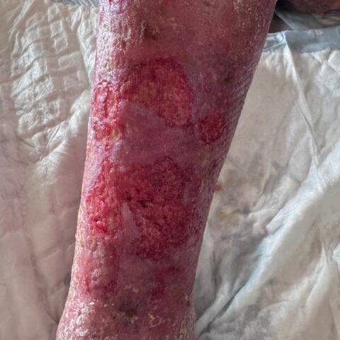 Comprendre les ulcères de jambe : causes et traitements - Actusoins